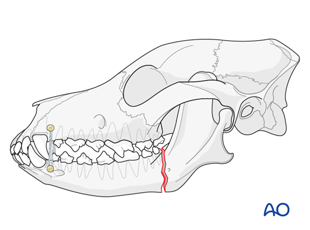 Intermaxillary fixation (IMF) screw and elastic chain for Mandible ...