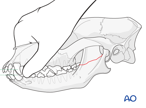 Maxillomandibular fixation (MMF) for Mandible, Ramus fractures