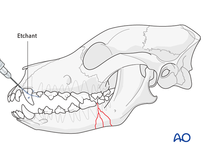 Maxillomandibular fixation (MMF) for Mandible, Caudal: Bilateral ...