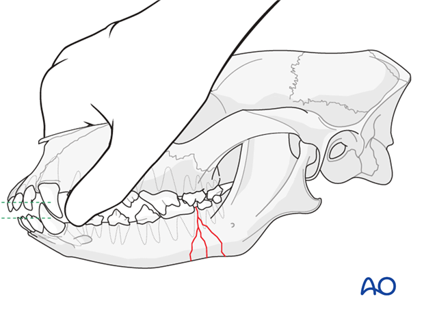 Maxillomandibular fixation (MMF) for Mandible, Caudal: Bilateral ...