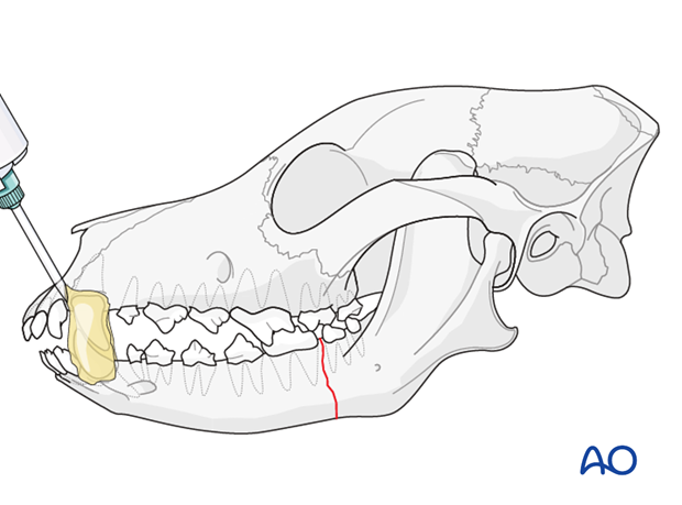 Maxillomandibular fixation (MMF) for Mandible, Caudal: Unilateral ...