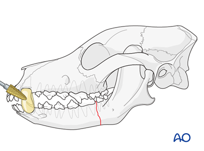 Maxillomandibular fixation (MMF) for Mandible, Caudal: Bilateral simple ...