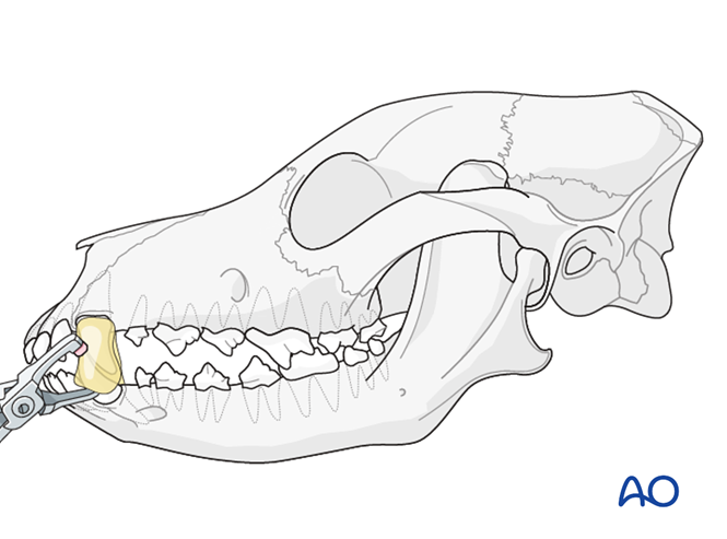 Maxillomandibular fixation (MMF) for Mandible, Caudal: Bilateral simple ...