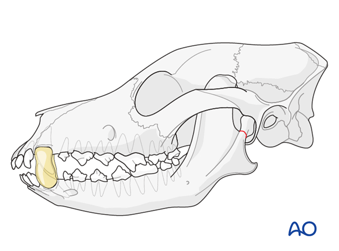 Maxillomandibular fixation (MMF) for Mandible, Temporomandibular joint ...