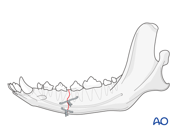 Intraosseous wiring for Mandible, Body: Unilateral simple fractures