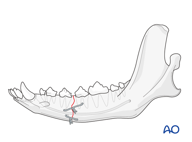 Intraosseous wiring for Mandible, Body: Unilateral simple fractures