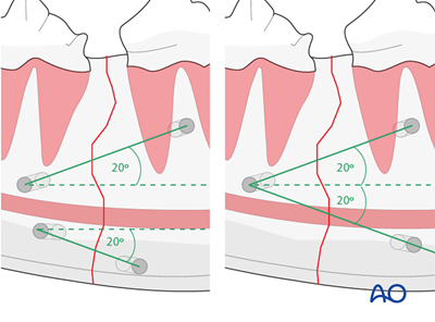 Intraosseous wiring for Mandible, Body: Unilateral simple fractures
