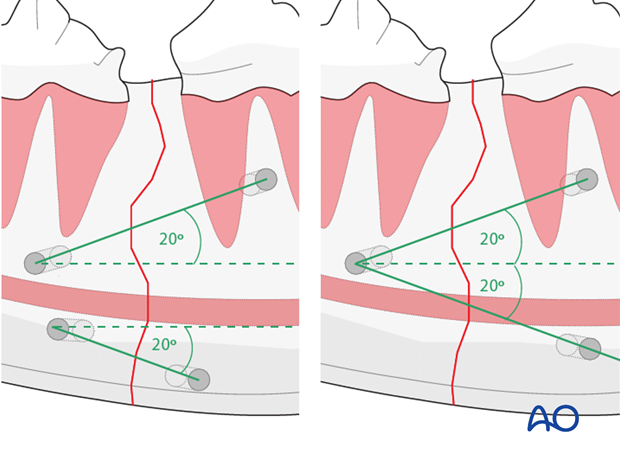 Mandible Fracture Wiring Maxillofacial Hardware: A Review Of