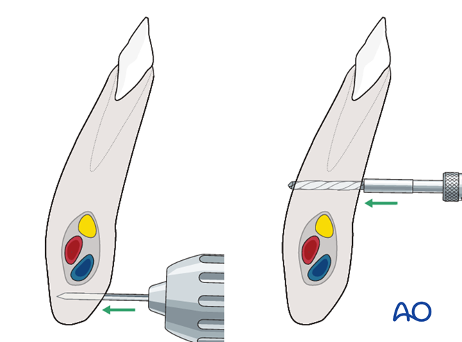 Intraosseous wiring for Mandible, Caudal: Unilateral simple fractures