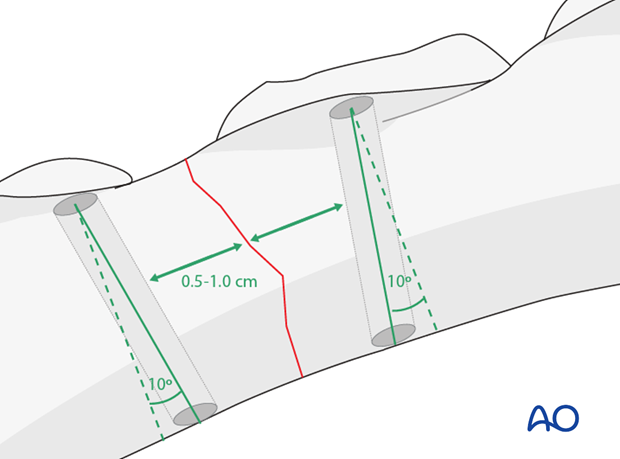 Intraosseous wiring for Mandible, Body: Unilateral simple fractures