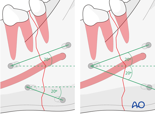 Intraosseous wiring for Mandible, Caudal: Unilateral simple fractures