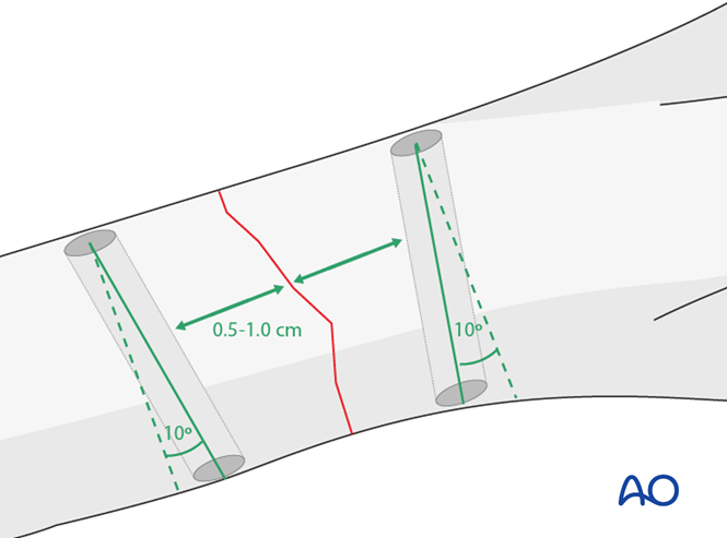 Intraosseous wiring for Mandible, Caudal: Unilateral simple fractures