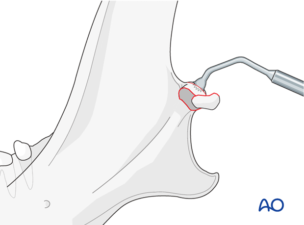 Condylectomy for Mandible, Temporomandibular joint fractures