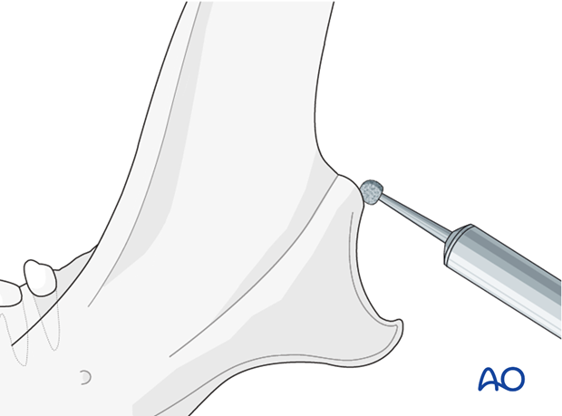 Condylectomy for Mandible, Temporomandibular joint fractures