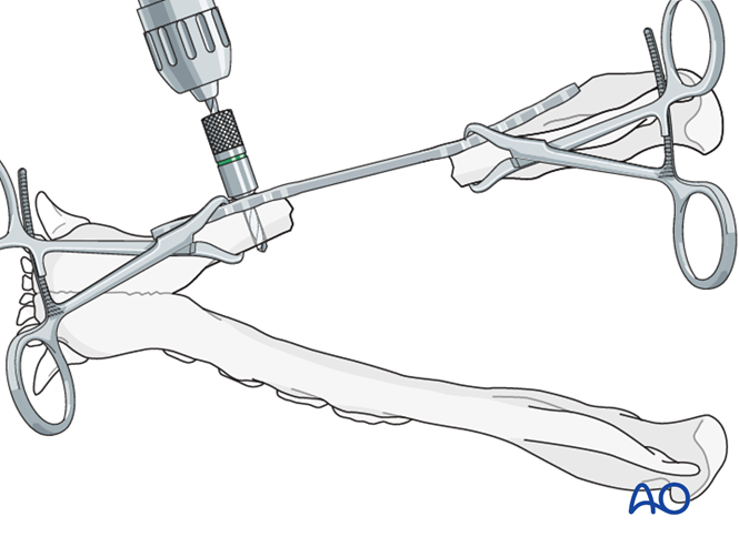Plate fixation for Mandible, Defect nonunion