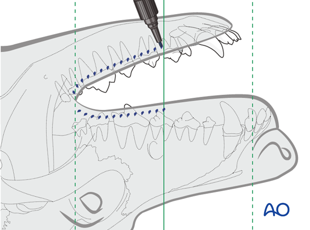 Salvage procedures for Mandible, Body: Unilateral comminuted fractures
