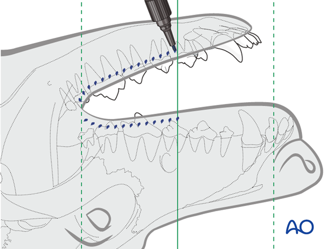 Salvage procedures for Mandible, Caudal: Bilateral comminuted fractures