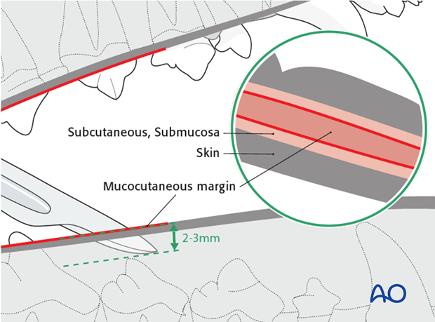 Salvage procedures for Mandible, Caudal: Bilateral comminuted fractures