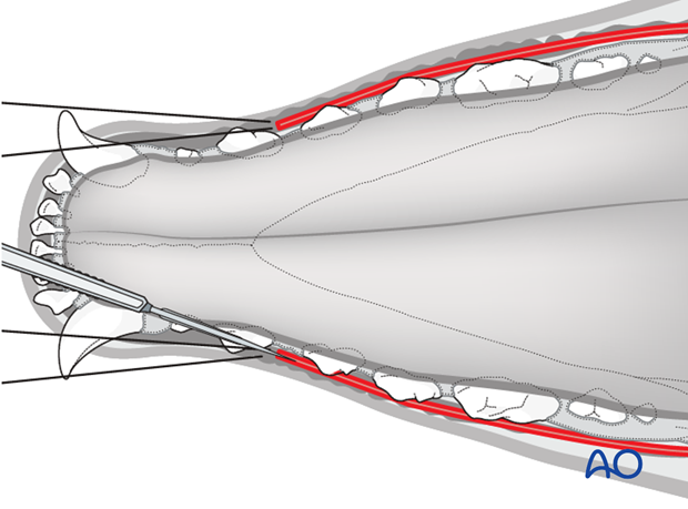 Salvage procedures for Mandible, Caudal: Bilateral comminuted fractures