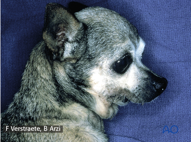 Salvage procedures for Mandible, Caudal: Bilateral comminuted fractures