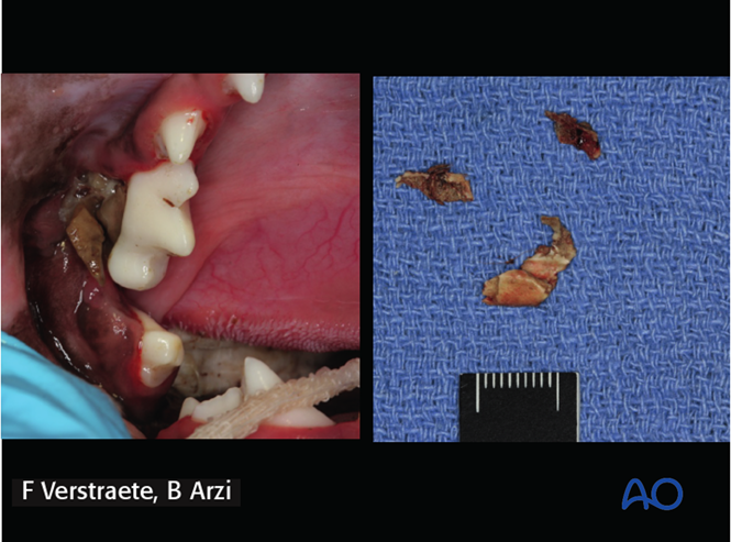 Complications with mandible fractures