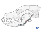 Treatment of Mandible, Ramus fractures