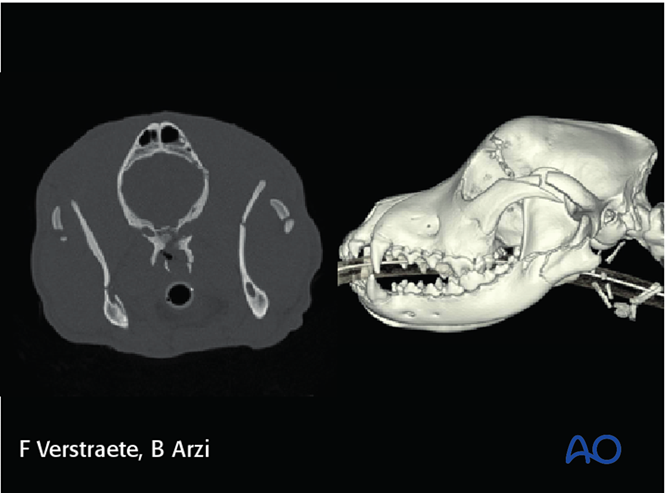 Maxillomandibular fixation (MMF) for Mandible, Ramus fractures