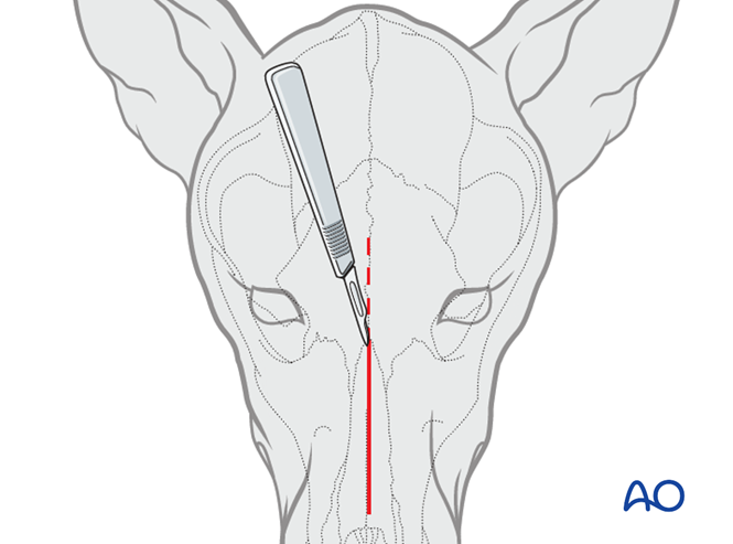 Plate fixation for Midface, Rostral: Simple fractures