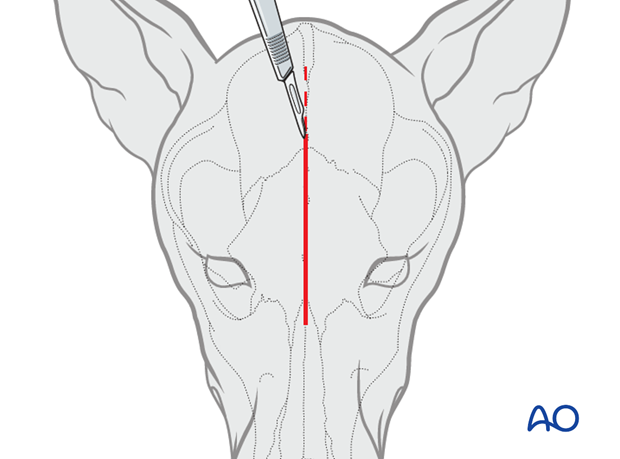 Dorsal midline approach
