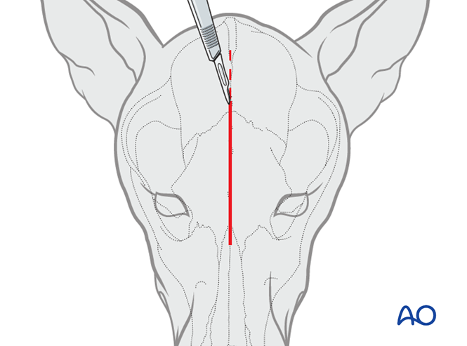 Dorsal midline approach