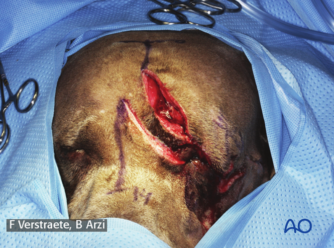 Dorsal midline approach