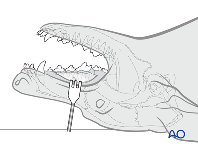 Intraoral approach to the maxilla