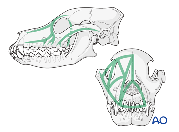Plate fixation for Midface, Panfacial: Nondisplaced fractures