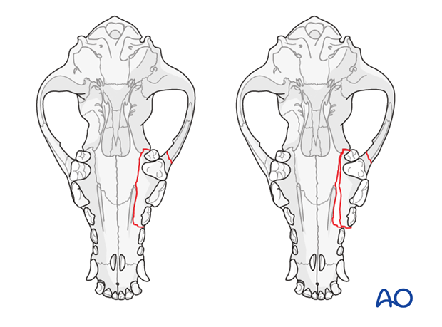 Non- or minimally displaced palatal fractures