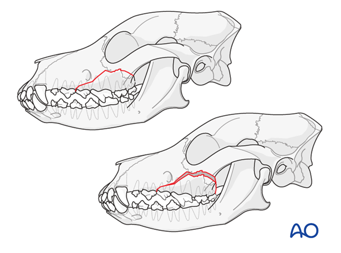Simple caudal midface fractures