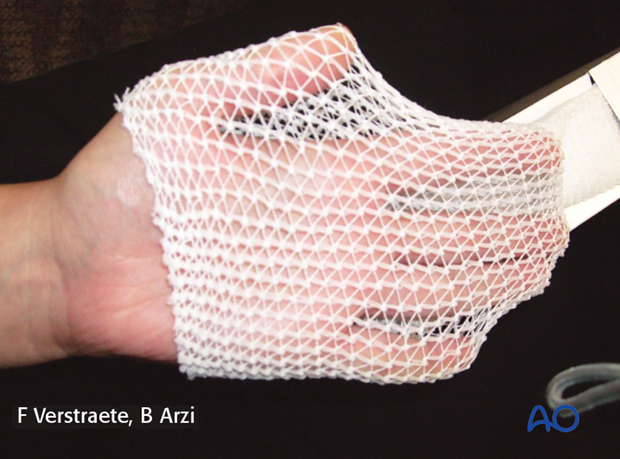 Nonsurgical fracture management for Midface, Caudal: Simple fractures