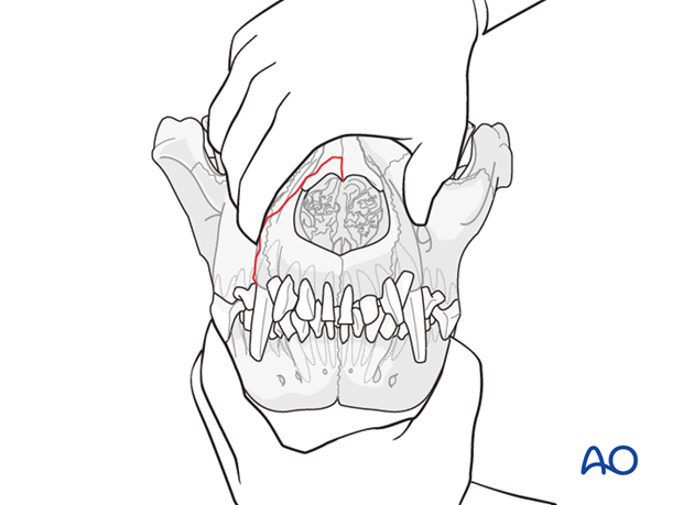 Intraoral splint fixation for Midface, Rostral: Simple fractures