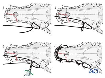 Intraoral splint fixation for Midface, Rostral: Simple fractures