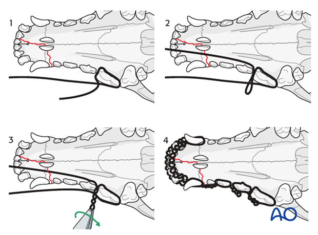 Intraoral splint fixation for Midface, Rostral: Simple fractures