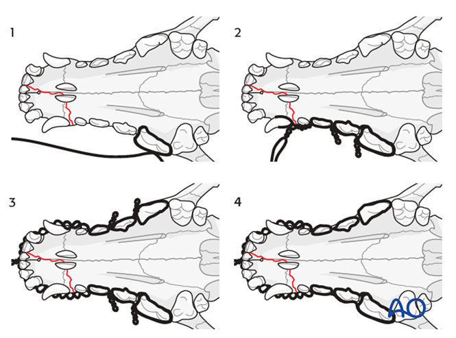 Intraoral splint fixation for Midface, Rostral: Simple fractures