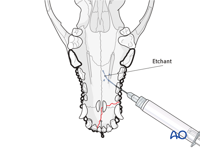 Intraoral splint fixation for Midface, Rostral: Simple fractures