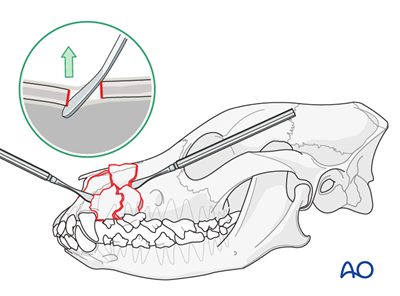 Plate fixation for Midface, Rostral: Comminuted