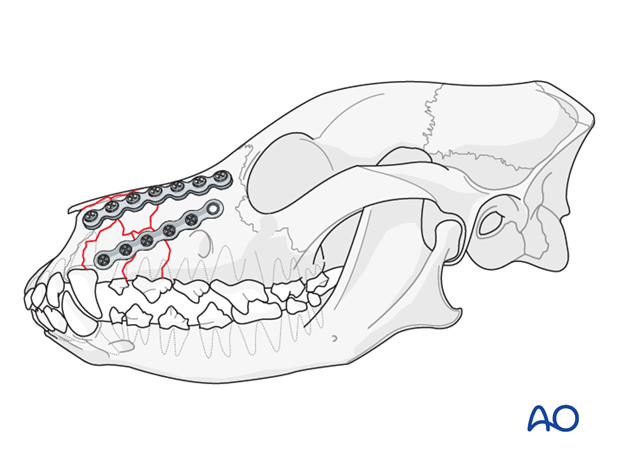 Plate fixation for Midface, Rostral: Simple fractures