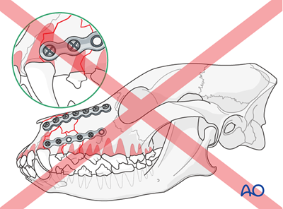 Plate fixation for Midface, Rostral: Simple fractures