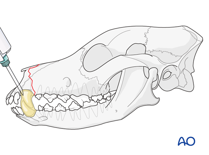 Maxillomandibular fixation for Midface, Rostral: Simple fractures