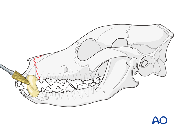 Maxillomandibular fixation for Midface, Rostral: Simple fractures