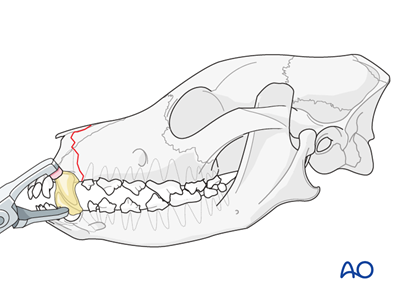 Maxillomandibular fixation for Midface, Rostral: Comminuted