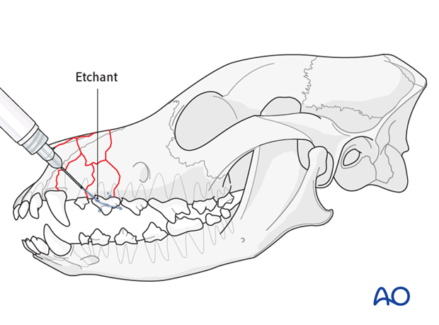 Maxillomandibular fixation for Midface, Rostral: Comminuted