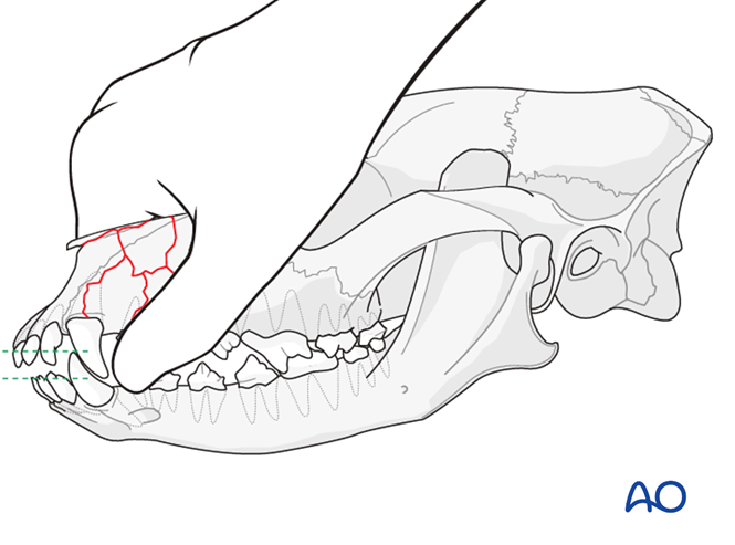 Maxillomandibular fixation for Midface, Rostral: Comminuted