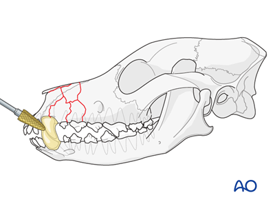 Maxillomandibular fixation for Midface, Rostral: Comminuted